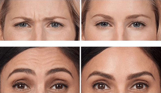 Botox-Before-and-After-Photo - Cherokee Women's Health